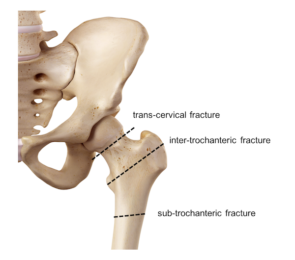 Proximal Femoral Fracture